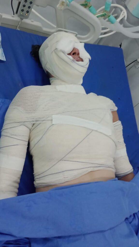Mulher sofre queimadura de 2° grau após panela de pressão explodir ao ...